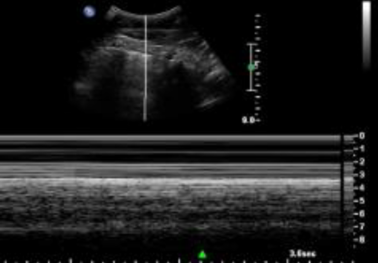 POCUS Made Easy: eFAST • LITFL • Ultrasound Library