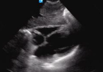 POCUS Made Easy: eFAST • LITFL • Ultrasound Library