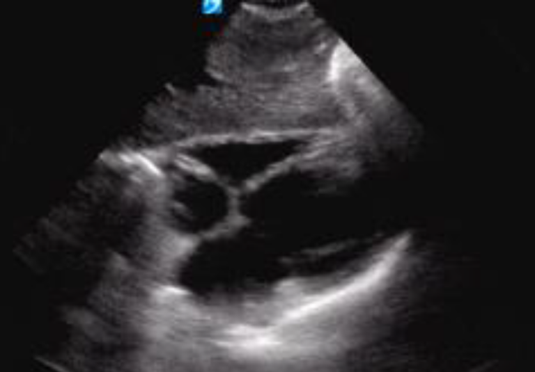POCUS Made Easy: eFAST • LITFL • Ultrasound Library