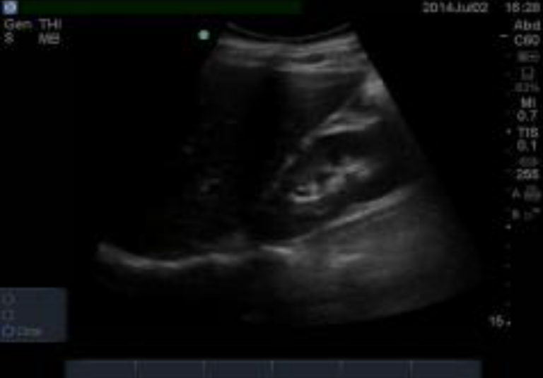 POCUS Made Easy: eFAST • LITFL • Ultrasound Library
