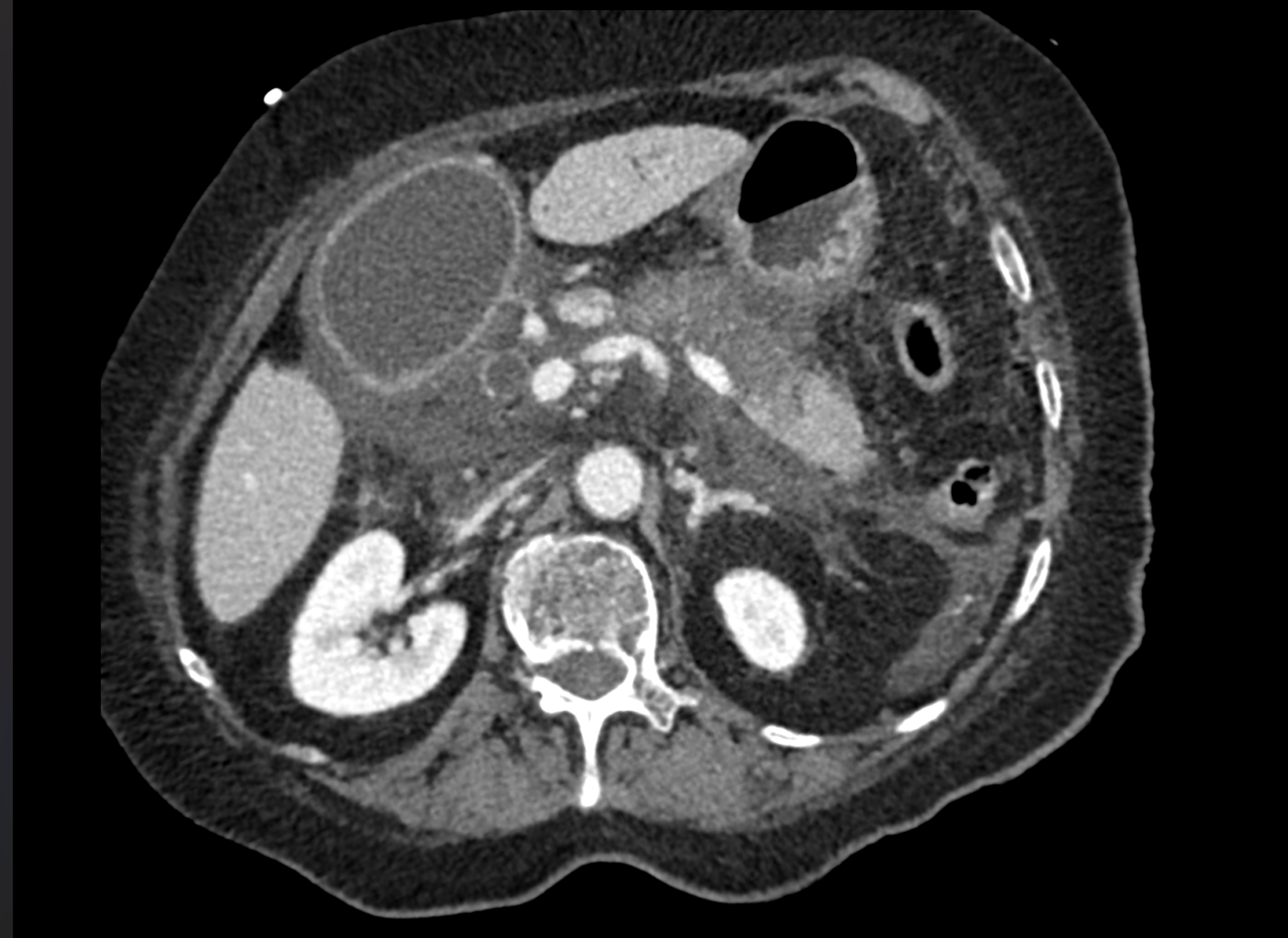 CT Case 036 • LITFL • CT scan interpretation