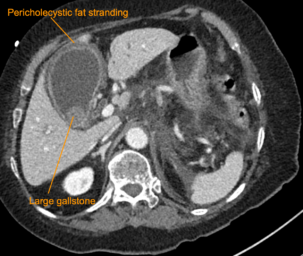 CT Case 036 • LITFL • CT scan interpretation