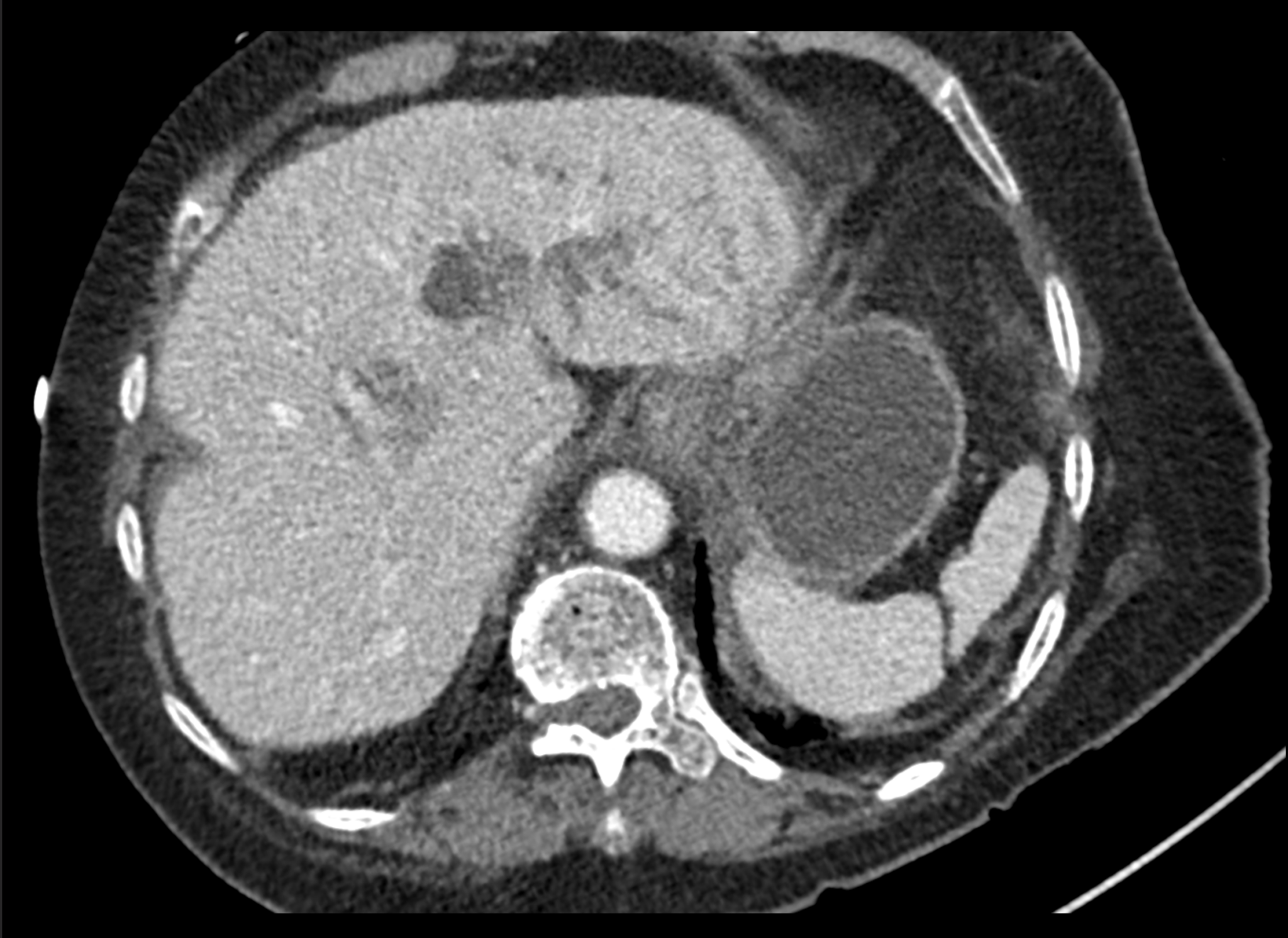 CT Case 036 • LITFL • CT scan interpretation