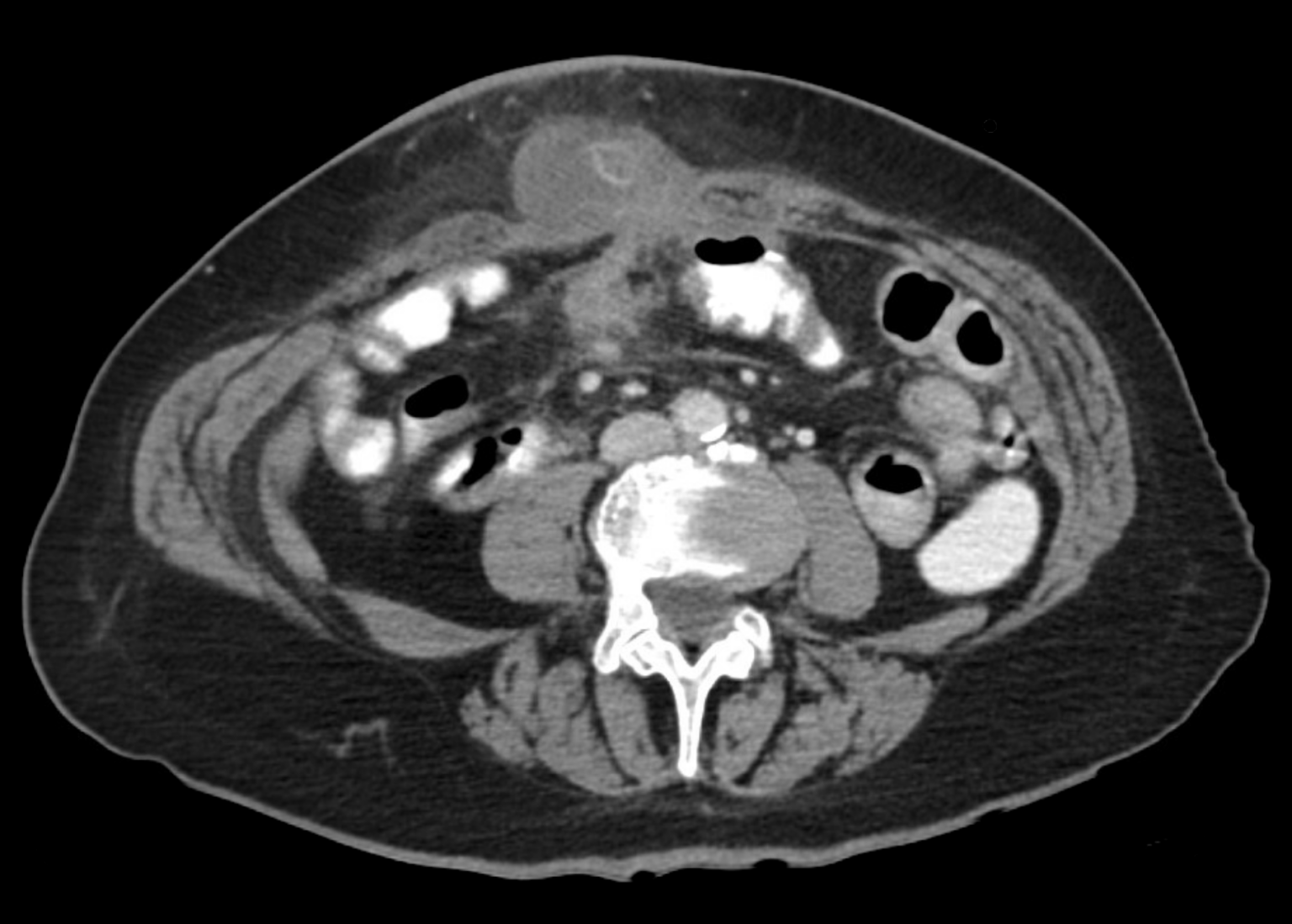 CT Case 039 • LITFL • CT scan interpretation