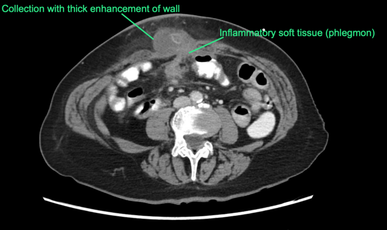 CT Case 039 • LITFL • CT scan interpretation