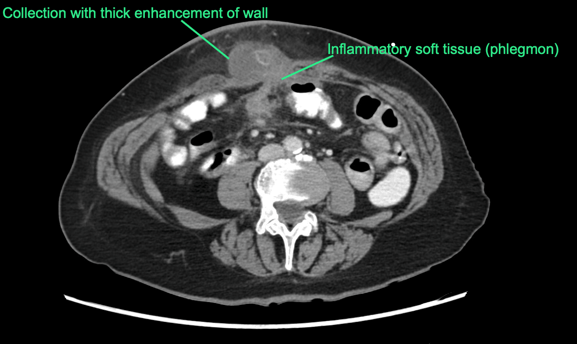 CT Case 039 LITFL CT Scan Interpretation CT Case 039 LITFL CT Scan Interpretation