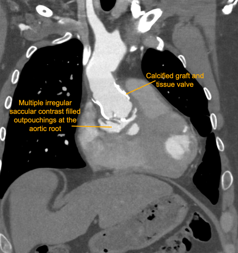 CT Case 041 • LITFL • CT scan interpretation