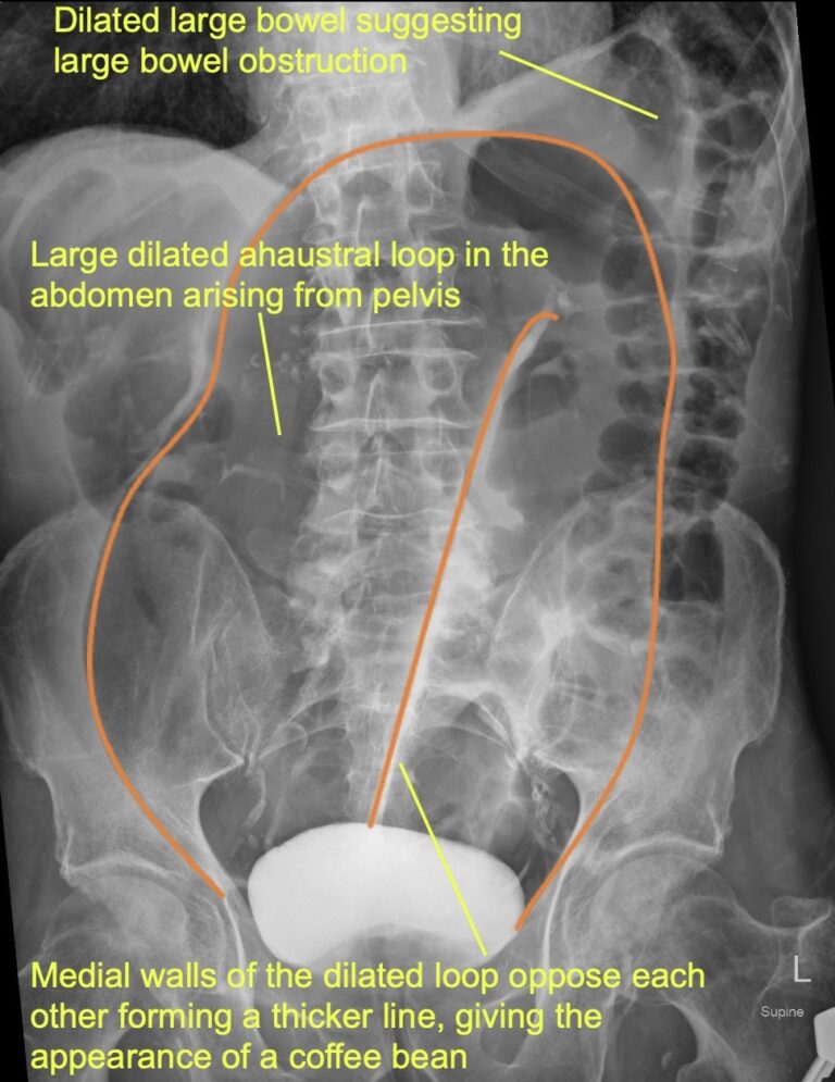 CT Case 044 • LITFL • CT scan interpretation