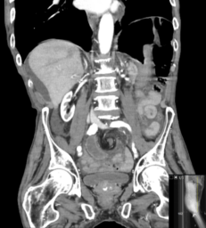 CT Case 044 • LITFL • CT scan interpretation