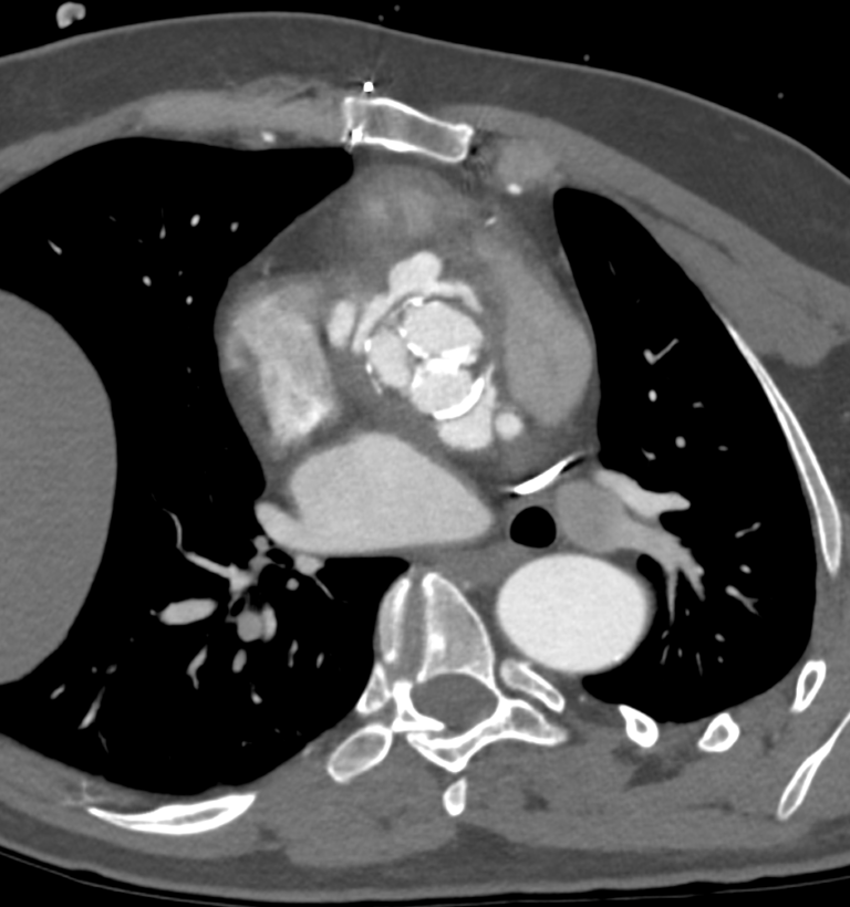 CT Case 041 • LITFL • CT scan interpretation