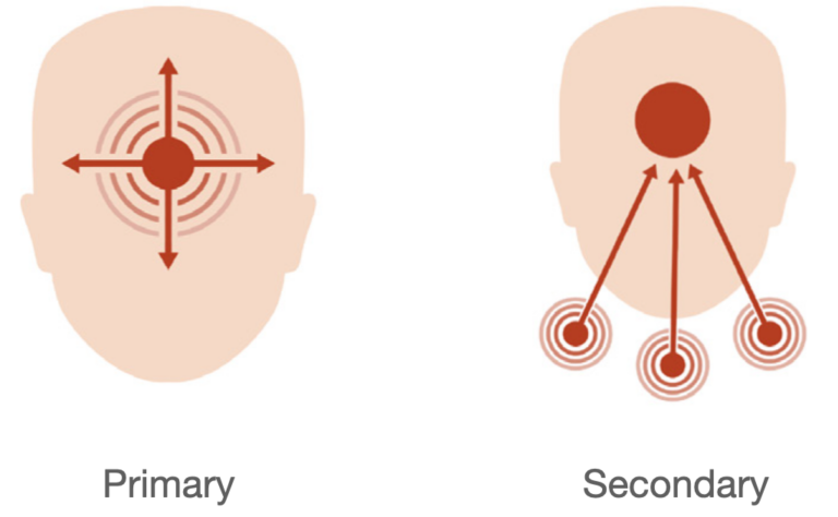Headache classification • LITFL • Neurology library