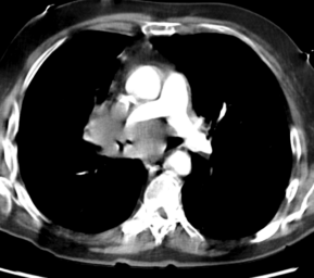 CT Case 046 • LITFL • CT scan interpretation