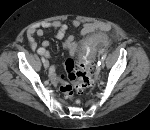 CT Case 047 LITFL CT Scan Interpretation CT Case 047 LITFL CT Scan Interpretation