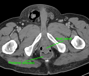 CT Case 051 • LITFL • CT scan interpretation