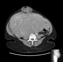 CT Case 052 • LITFL • CT scan interpretation