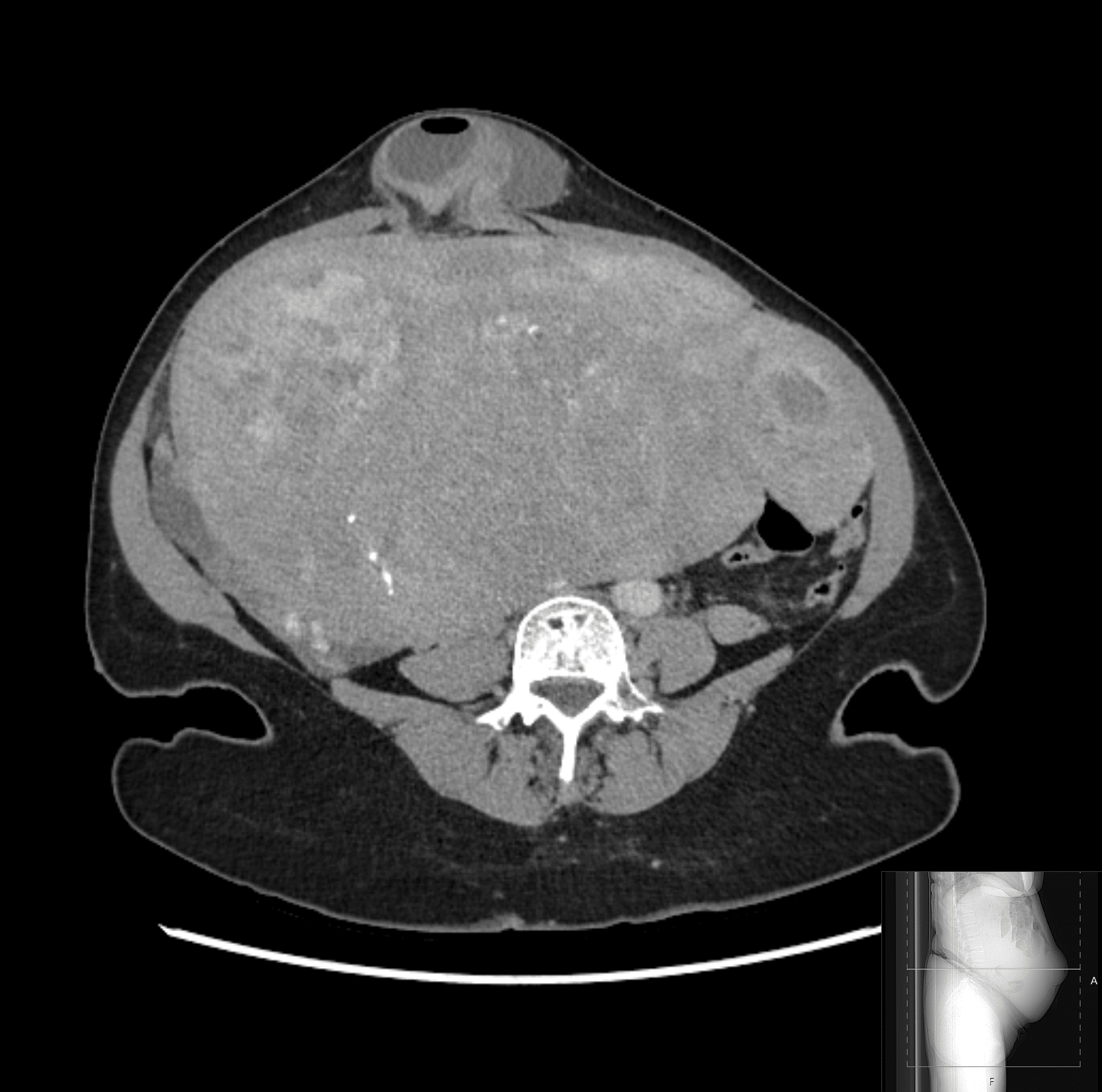 CT Case 052 • LITFL • CT scan interpretation