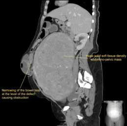 CT Case 052 • LITFL • CT scan interpretation
