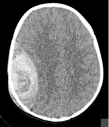 CT Case 055 • LITFL • CT scan interpretation