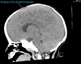 CT Case 055 • LITFL • CT scan interpretation