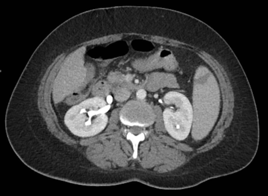 CT Case 056 • LITFL • CT scan interpretation