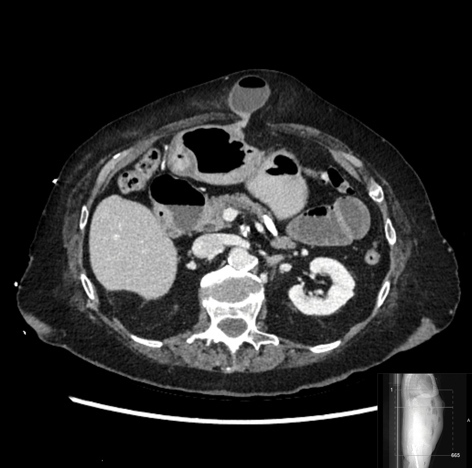 CT Case 057 • LITFL • CT scan interpretation