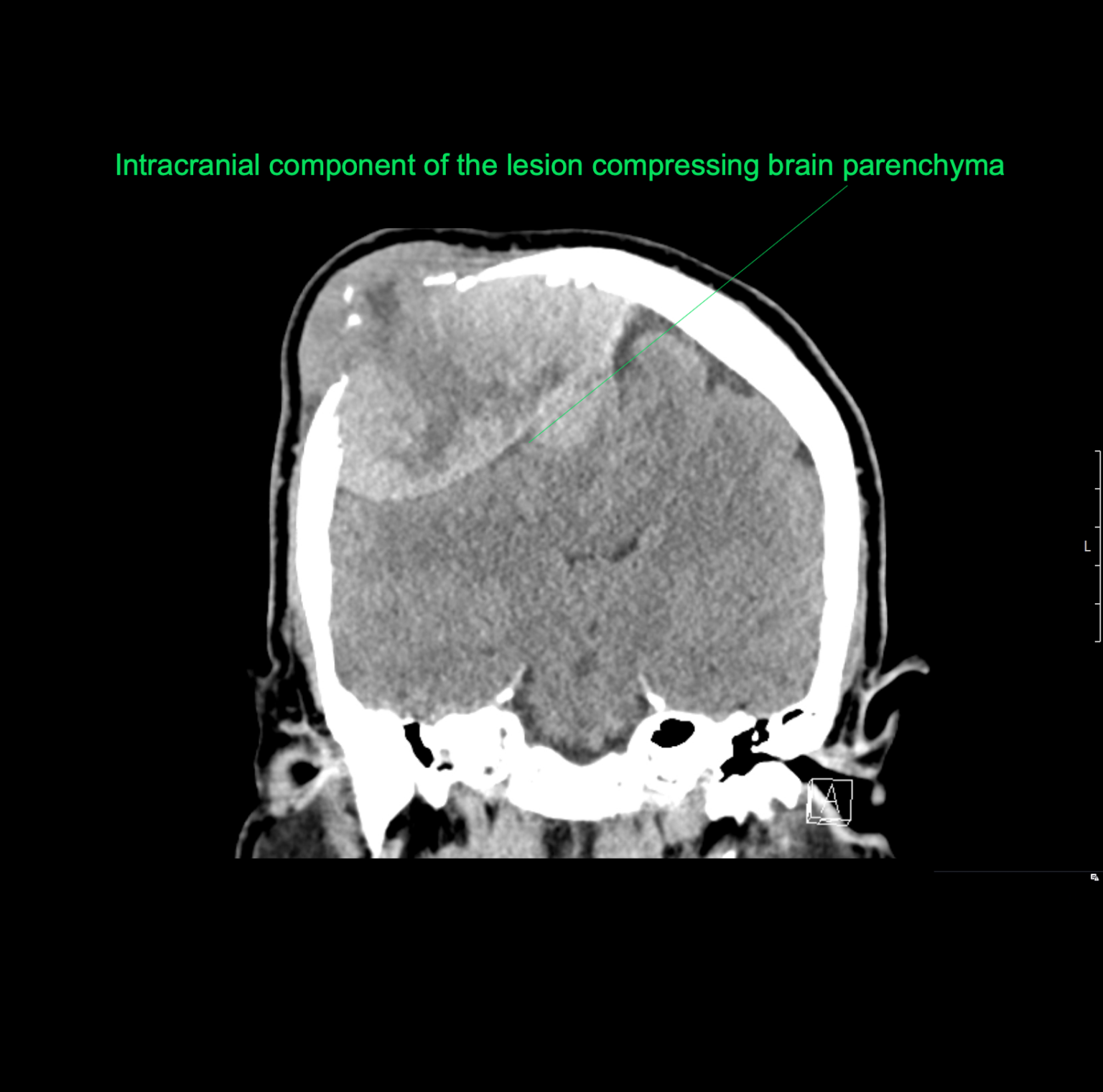 CT Case 060 • LITFL • CT scan interpretation