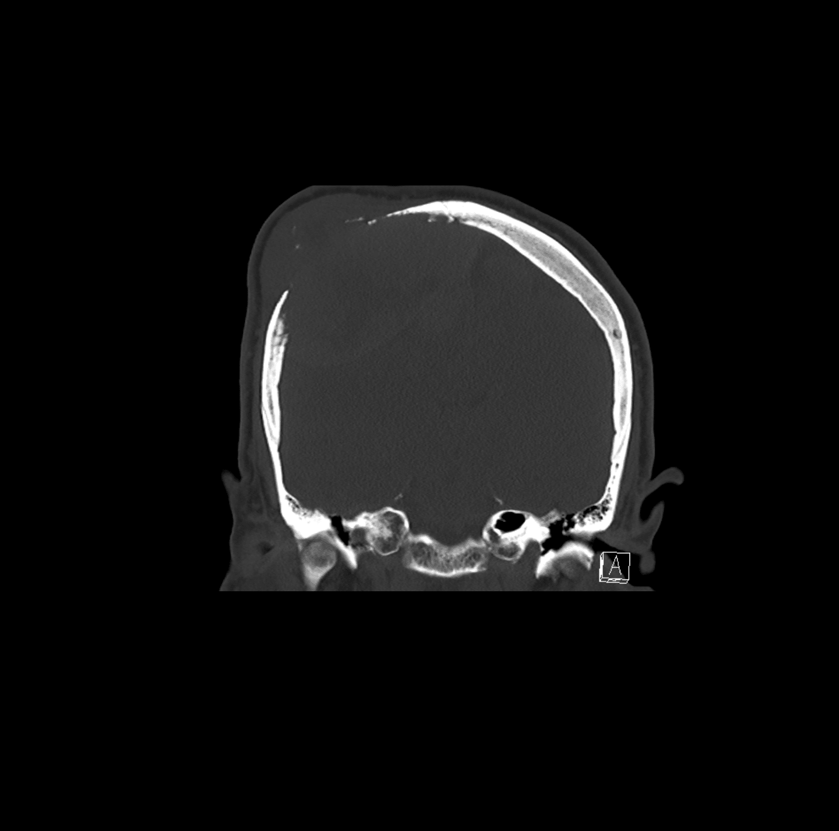 CT Case 060 • LITFL • CT scan interpretation