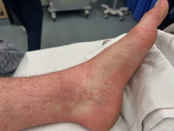 Scombroid Poisoning • LITFL • CCC Toxicology