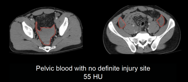 Abdominal CT: bowel and mesenteric trauma • LITFL • Radiology