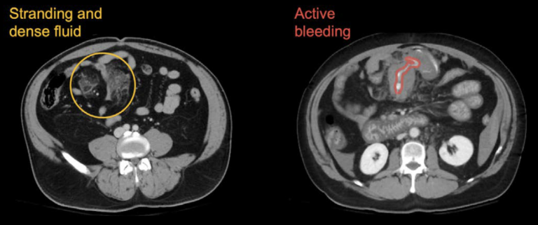 Abdominal CT: bowel and mesenteric trauma • LITFL • Radiology