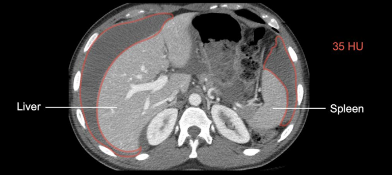 Abdominal CT: solid organ injuries • LITFL • Radiology Library