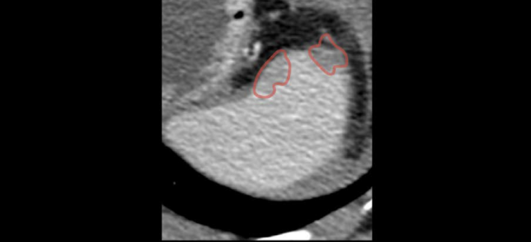 Abdominal CT: spleen, liver, and pancreas injury • LITFL