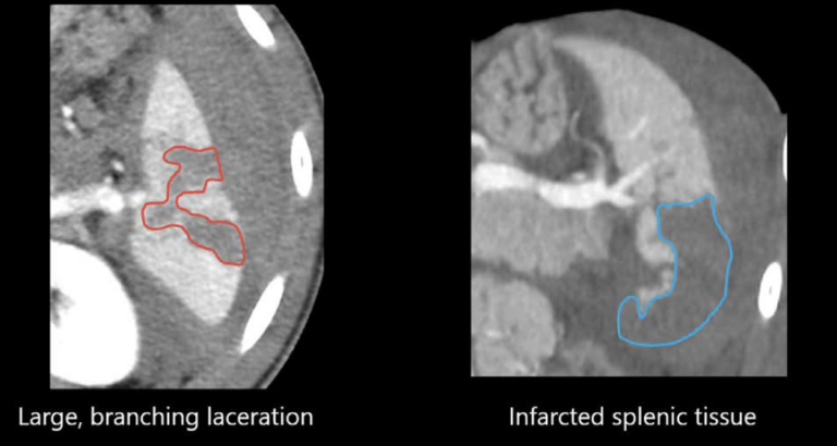 Abdominal CT: spleen, liver, and pancreas injury • LITFL