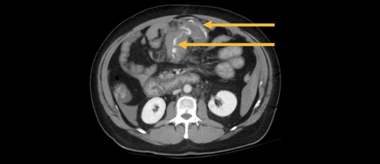 Abdominal CT: solid organ injuries • LITFL • Radiology Library