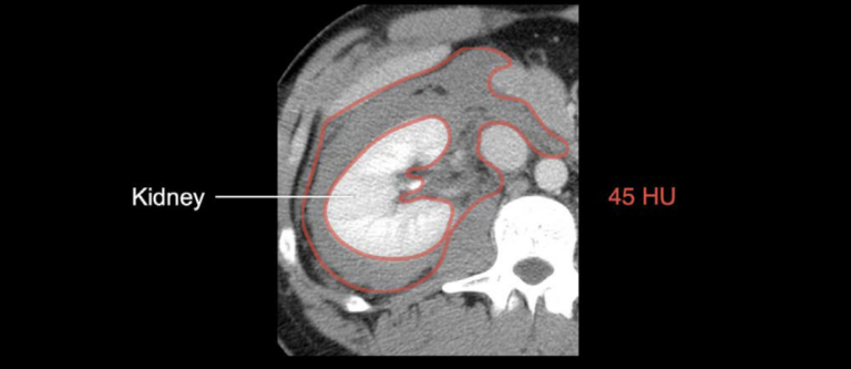 Abdominal CT: solid organ injuries • LITFL • Radiology Library