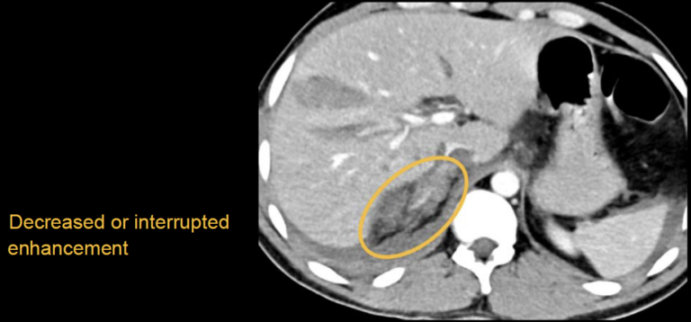 Abdominal CT: renal, ureter, and adrenal injury • LITFL