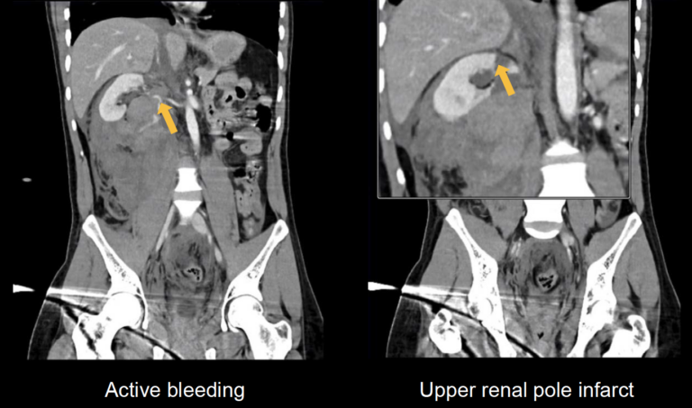 Solid organ injury (case study) • LITFL • Radiology Library