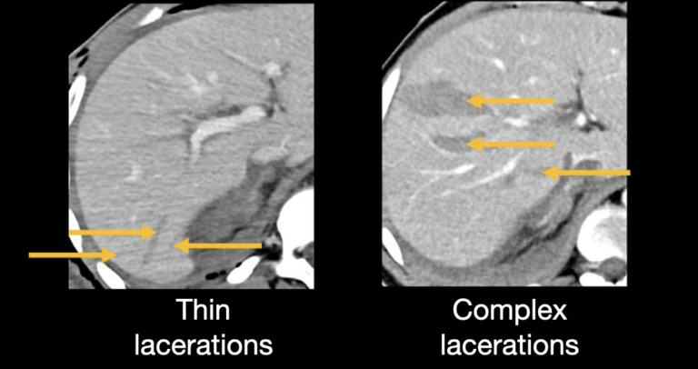 Abdominal CT: spleen, liver, and pancreas injury • LITFL