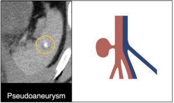 Abdominal CT: spleen, liver, and pancreas injury • LITFL