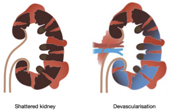 Abdominal CT: renal, ureter, and adrenal injury • LITFL