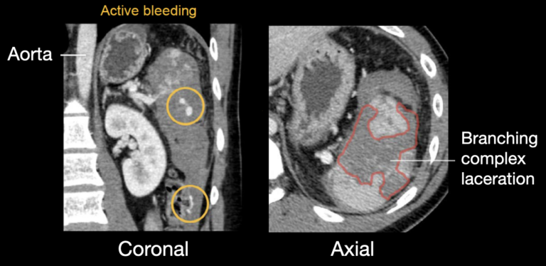 Abdominal CT: spleen, liver, and pancreas injury • LITFL