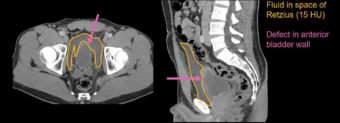 Abdominal CT: bladder injuries • LITFL • Radiology