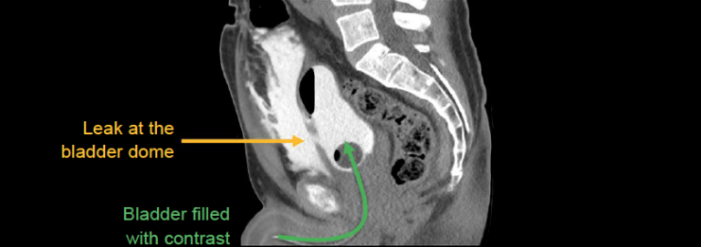 Abdominal CT: bladder injuries • LITFL • Radiology