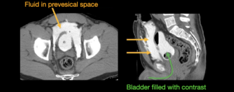 Abdominal CT: bladder injuries • LITFL • Radiology