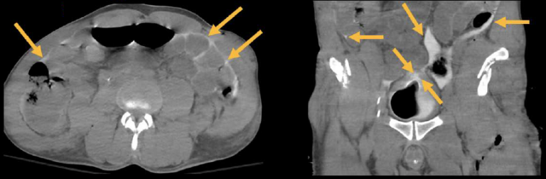 Abdominal CT: bladder injuries • LITFL • Radiology
