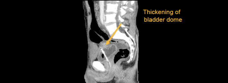Abdominal CT: bladder injuries • LITFL • Radiology