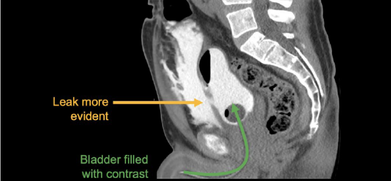 Abdominal CT: bladder injuries • LITFL • Radiology