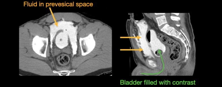 Abdominal CT: bladder injuries • LITFL • Radiology