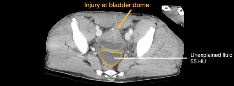 Abdominal CT: bladder injuries • LITFL • Radiology