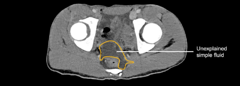 Abdominal CT: bladder injuries • LITFL • Radiology